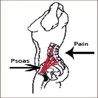 Psoas Muscle Pain Treatment